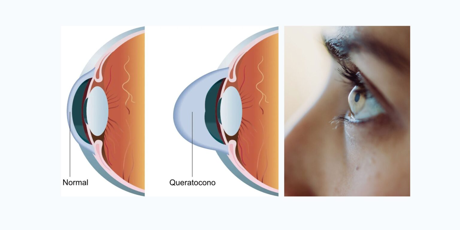 Operación de queratocono en México - Oftalmóloga Dra. Elvia