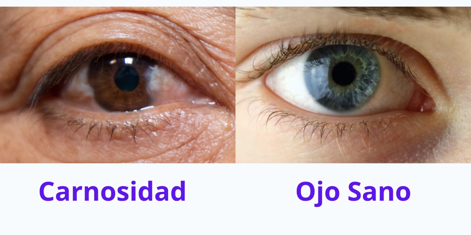 Por qué sale carnosidad en los ojos: causas y síntomas - Oftalmóloga ...